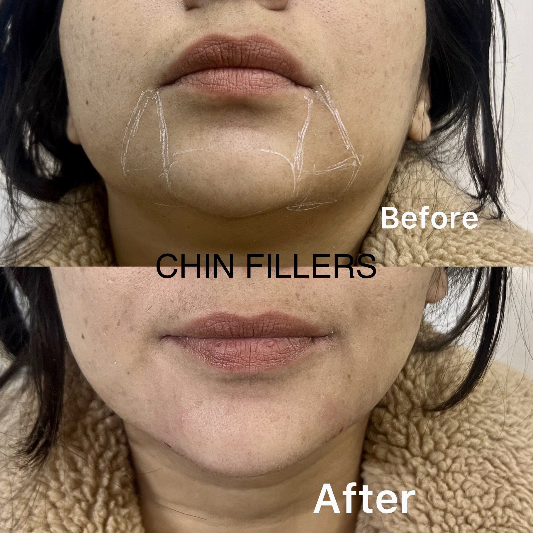 Best Chin Enhancement using Fillers by Dr. Swati Garg - Smart Skin ...